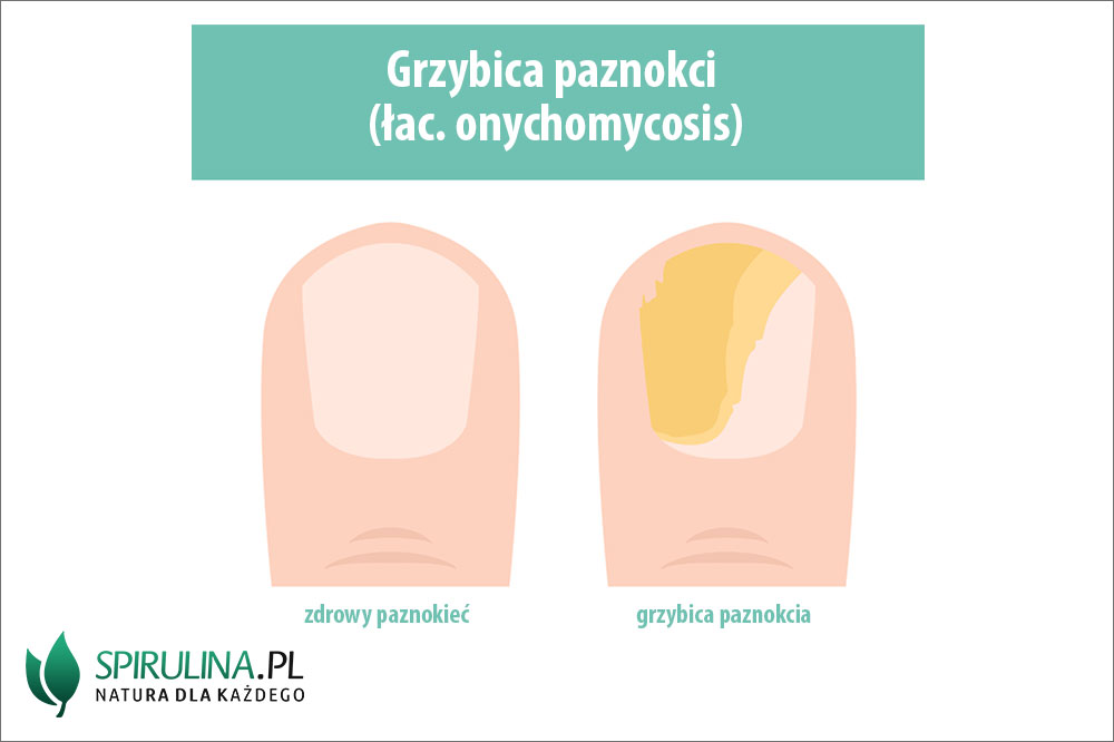 Grzybica paznokci - rodzaje i leczenie - algi Spirulina i Chlorella