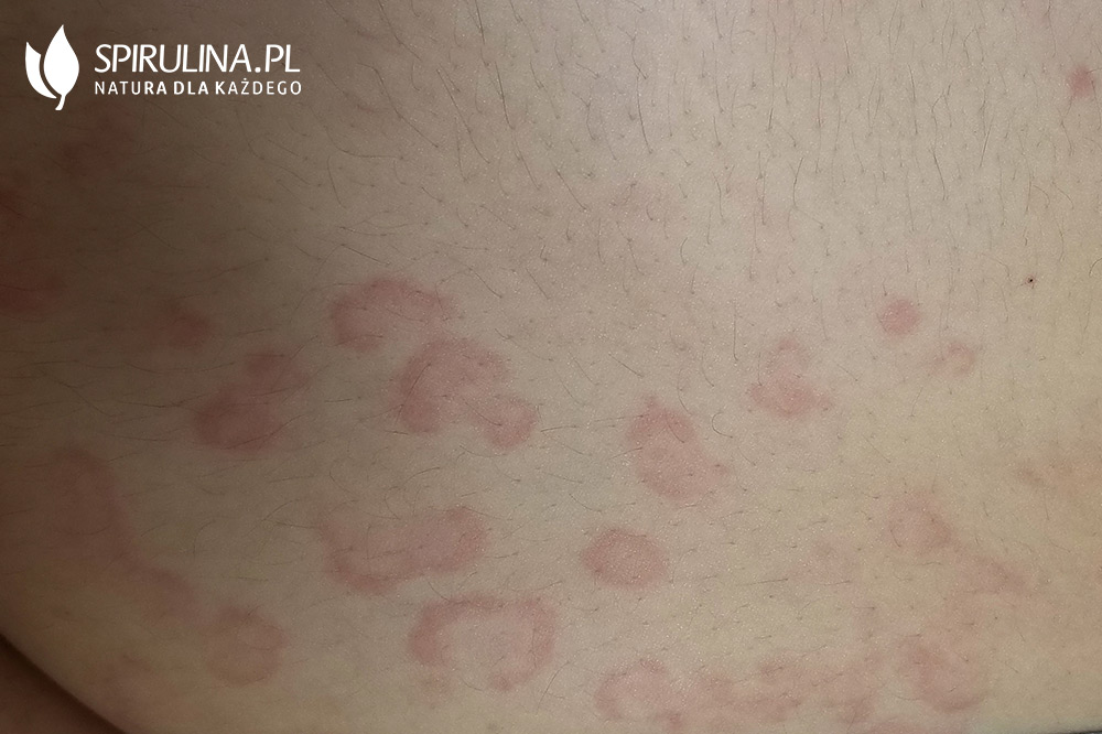Erythema Multiforme Annular Erythematous Targetoid Skin Lesions Stock ...