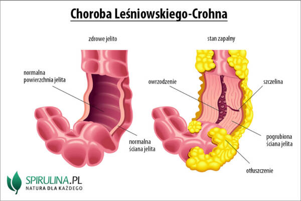 Choroba Leśniowskiego-Crohna - algi Spirulina i Chlorella