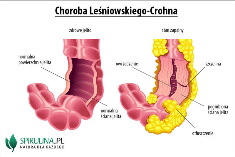 Choroba Leśniowskiego-Crohna - algi Spirulina i Chlorella
