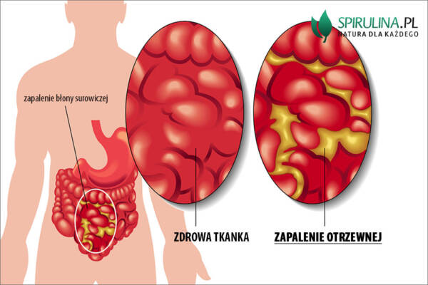 Zapalenie otrzewnej - algi Spirulina i Chlorella