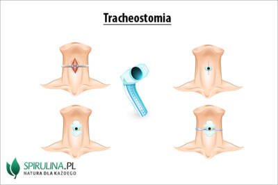 Tracheostomia - algi Spirulina i Chlorella