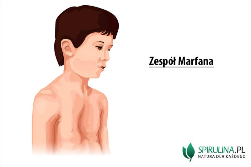 Zespół Marfana - algi Spirulina i Chlorella