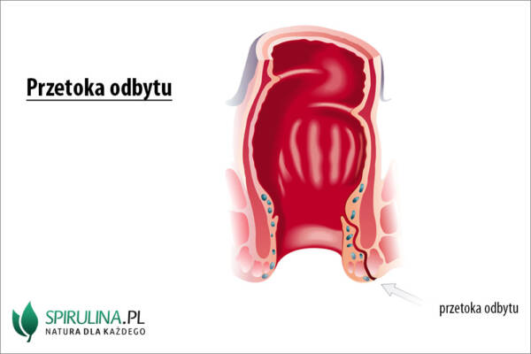 Przetoka odbytu - algi Spirulina i Chlorella