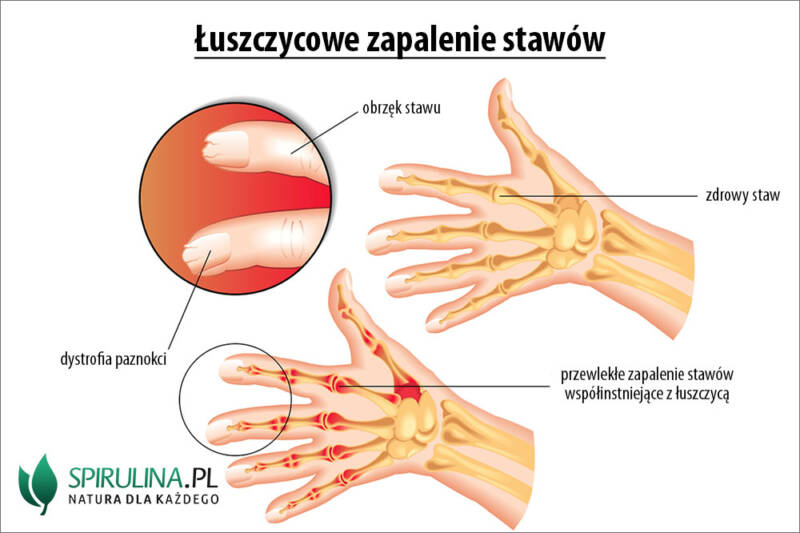 Łuszczycowe zapalenie stawów - algi Spirulina i Chlorella